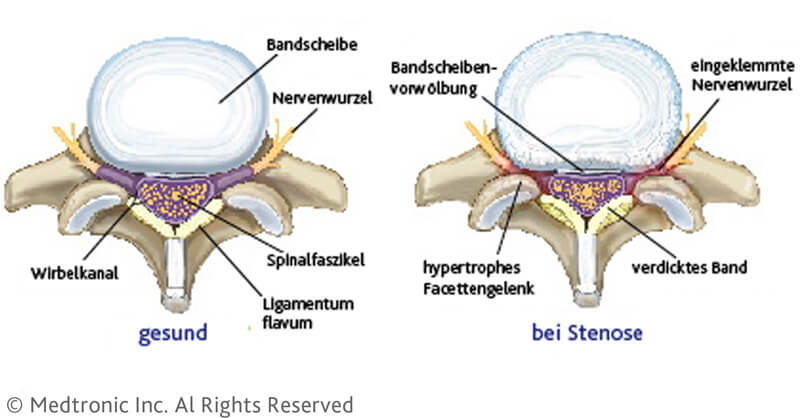 Stenose - Ursache und Behandlung- Dr. Tuschel